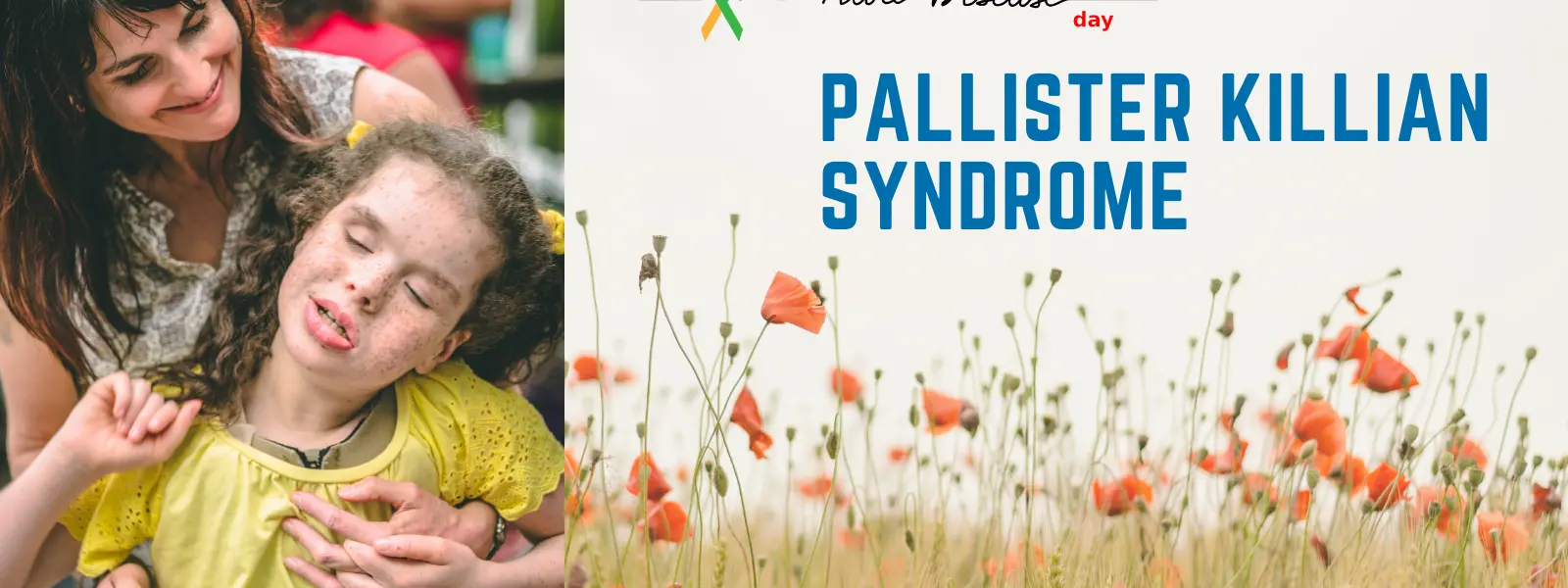 Pallister Killian Syndrome: An Often Undiagnosed Rare Genetic Disease ...